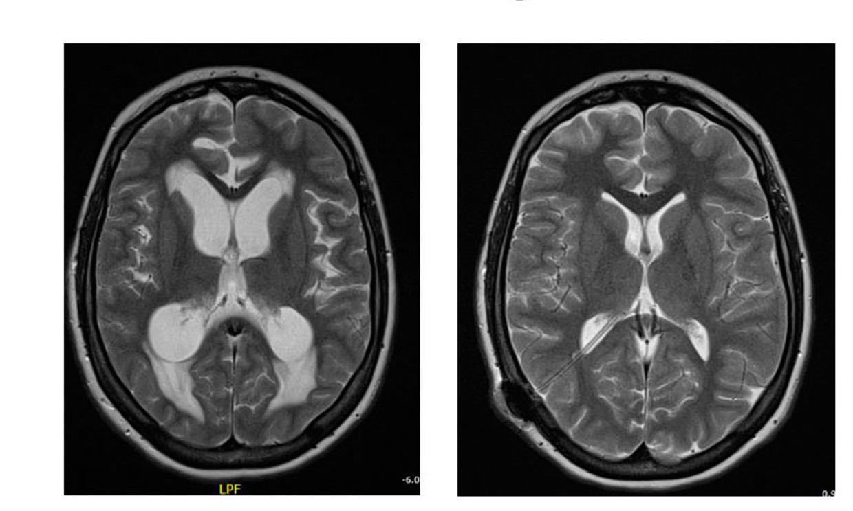 Waterhoofd bij je baby - Ouders van Nu