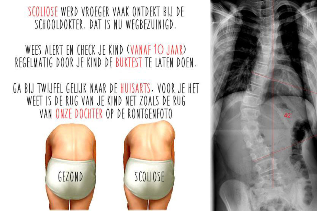 Scoliose, wat is dat precies? - Ouders van Nu