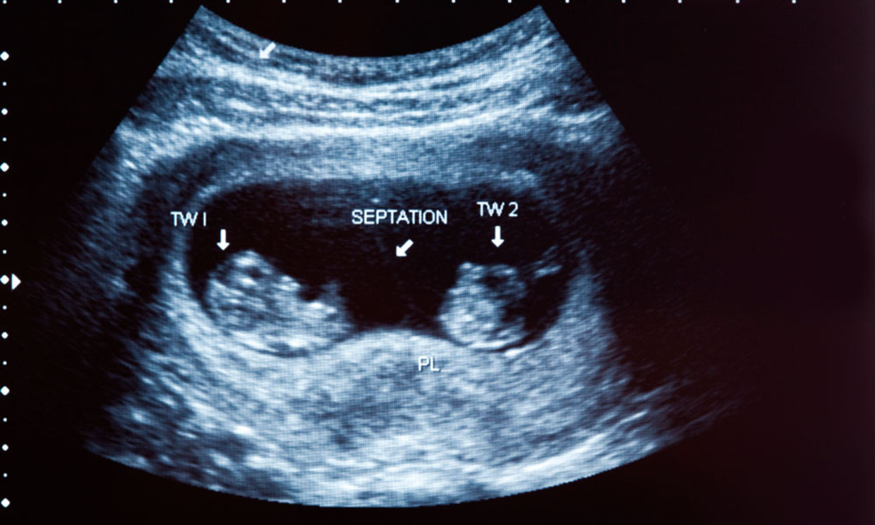 Eeneiige tweeling of twee-eiige tweeling - Ouders van Nu