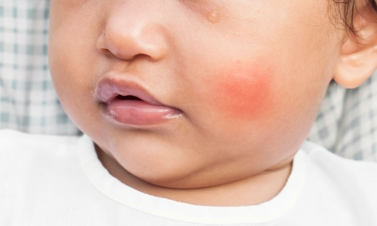 Een (rode) mierenbeet bij je kind - Ouders van Nu